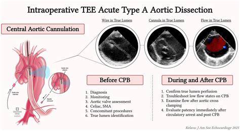 Intraoperative Transesophageal Echocardiography In Acute Type A Aortic