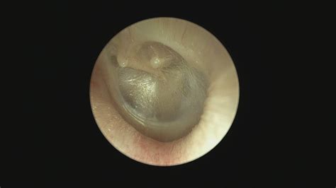Tympanic Membrane Retraction Robert Nash