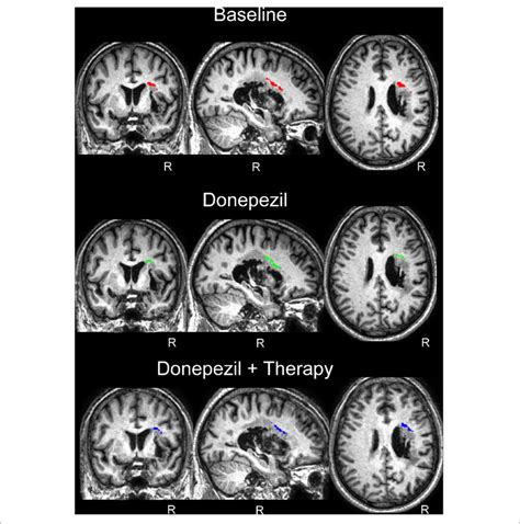 White Matter Voxel Based Morphometry Vbm Results In The Fat Region Download Scientific