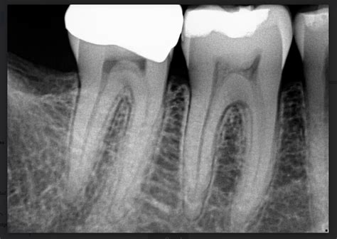 Did Crown Prep Here Go Too Far R Askdentists