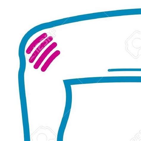 Ok So Im No Expert On This But Rcppdorpseudogout