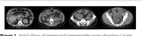 Figure 1 From Low Grade Appendiceal Mucinous Neoplasm Lamn As A Mimicker Of Perforated