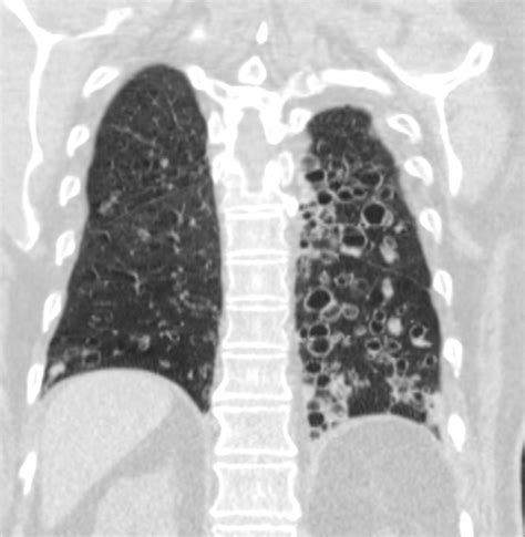 088lu Copd Bronchiectasis The Common Vein