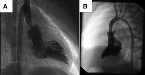 Cardiovascular Disease In Williams Syndrome Circulation