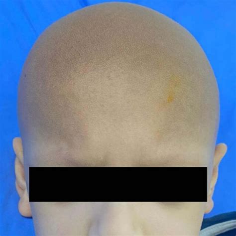 Numerous Non Inflammatory Follicular Keratotic Tiny Papules On The