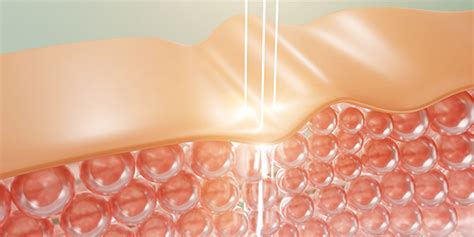 안티에이징 1 페이지 영종도 예스피부과의원