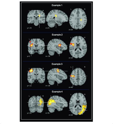 examples of stroke lesion segmentation examples of voxel based