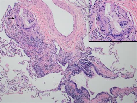 Diffuse Aspiration Bronchiolitis Analysis Of 20 Consecutive Patients Pmc