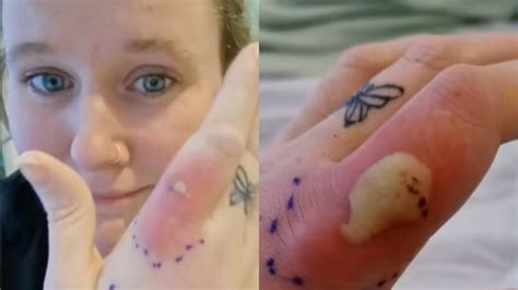 Rabbit Spider Bite At Toby Skene Blog