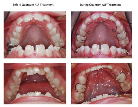 Orthodontic Appliance Before And After At Victoria Jenkins Blog