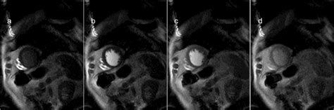 Saturation Recovery Truefisp Perfusion Images Combined With Ipat