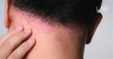 เชอราบนหนงศรษะรกษาอยางไร และตางจากโรคสะเกดเงนยงไง