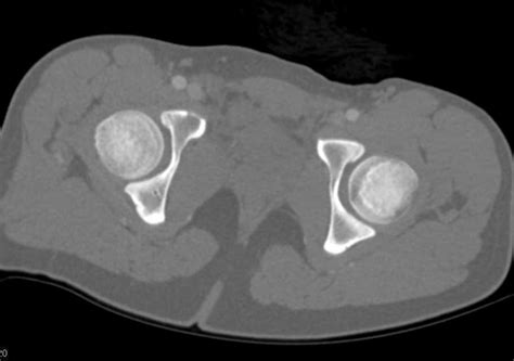 Fracture Of The Right Superior And Inferior Pubic Ramus With Negative Angiogram Vascular Case