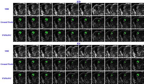 Figure 8 From Toward Right Ventricle Segmentation In Cardiac Mris Via Feature Multiplexing And