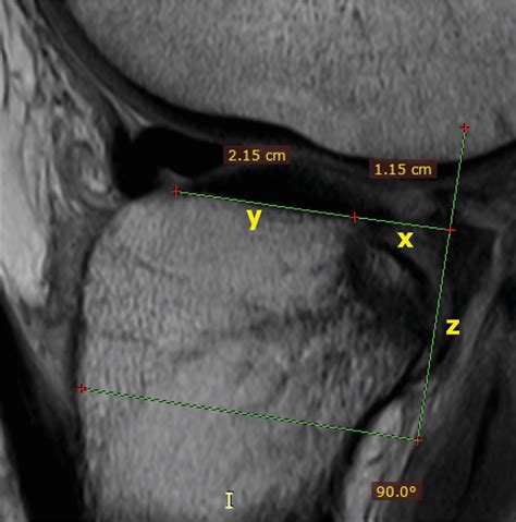 Figure 1 From High Grade Posterolateral Tibial Plateau Impaction Fractures In The Setting Of A