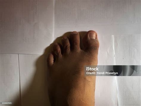 Photo Of A Single Bare Foot Against A White Background Shows Toes Skin
