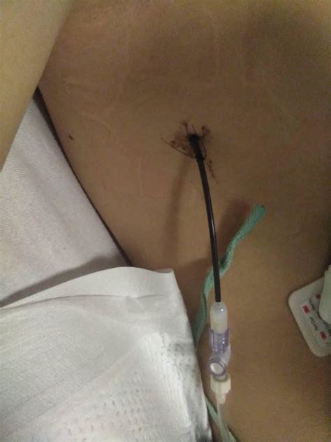 Pics From My Botched Pacemaker Implant Hematoma Collapsed Right Lung