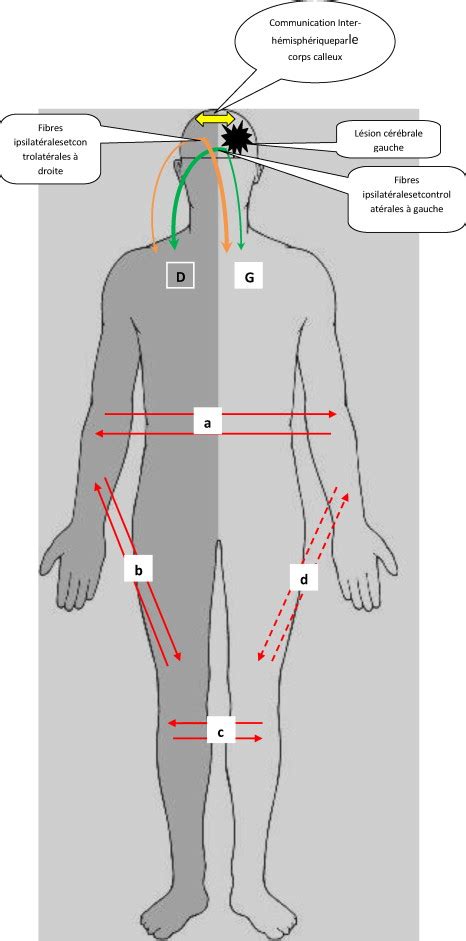 Interlimb Neural Coupling Implications For Poststroke Hemiparesis