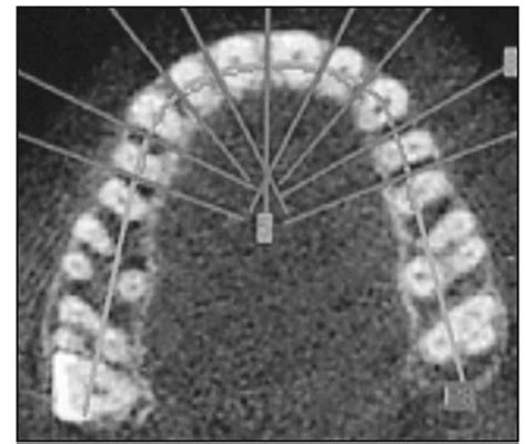 In The Anterior Maxillary Arch From Right First Premolar To