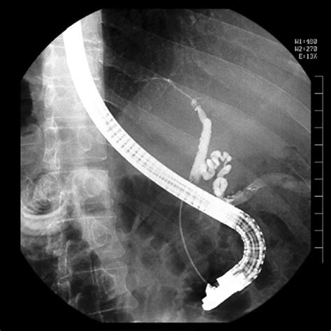 Endoscopic Retrograde Cholangiopancreatography ERCP