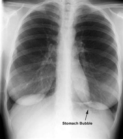 Cxr Pe醫學縮寫 Sword