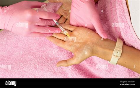 Beautician Makes Intramuscular Injections Of Botulinum Toxin In Palm Against Hyperhidrosis