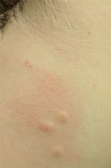 Three Bites In A Triangle Shape