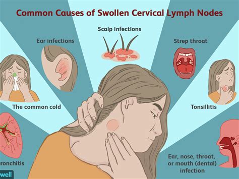 What Causes Swollen Supraclavicular Lymph Nodes Moodbery