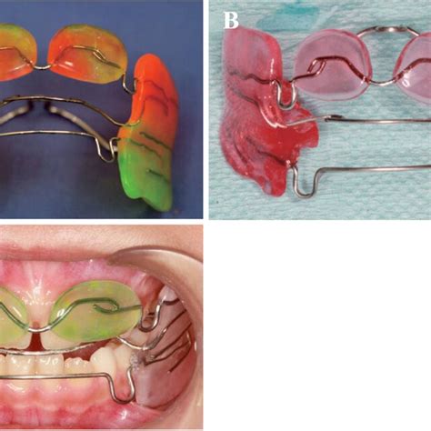 Fr Iii Functional Appliance A Without Repositioning Occlusal Plate