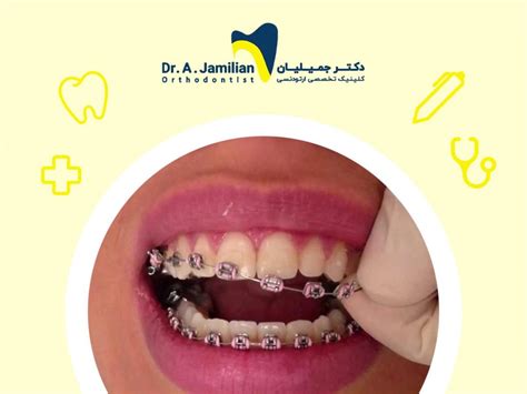 How To Remove Orthodontic Brackets Dr Jamilian