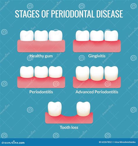 Periodontal Disease Chart Vector Illustration 62267852