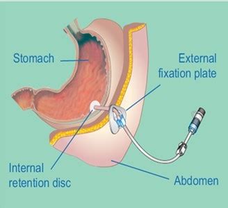 Your Guide To Peg Tube Feeding Frimley Health Nhs Foundation Trust