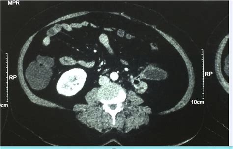 A Contrast Enhanced Computed Tomography Ct Scan Of Abdomen And Pelvis