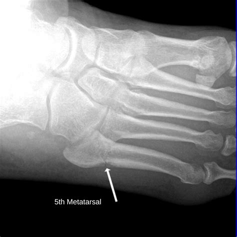 Metatarsal Bone Pain