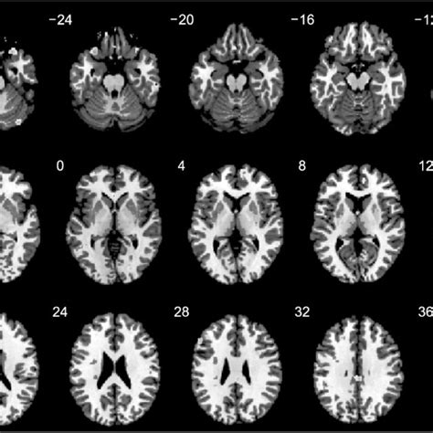 Statistical Parametric Maps Showing Group Differences Greater Download Scientific Diagram
