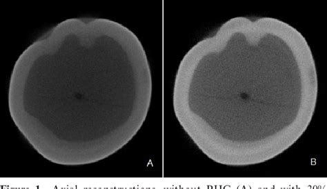 Figure 1 From Beam Hardening Correction Tool Improves The Diagnosis Of