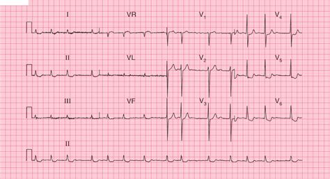 Ecg Case 147 Digoxin Effect With Possible Digoxin Toxicity Manual Of Medicine