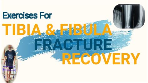 Exercise For Tibia And Fibula Fracture Recovery After Surgery Youtube