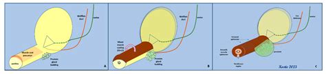 Prostatectomy Diagram
