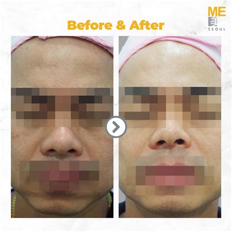 Glutathione Injection Before And After Photos Blog Me Clinic Seoul