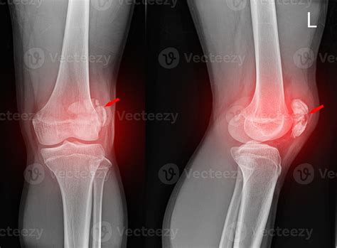 A Film X Ray Of Left Knee Lateral View Shown Fracture Of Knee Cap