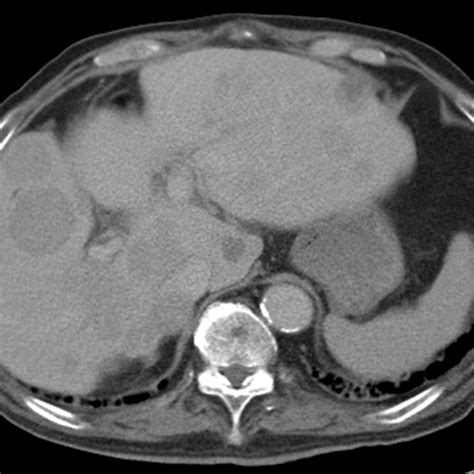 Algorithm For Patients With Elevated Ferritin And Suspected Iron Overload Download Scientific