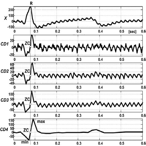 Qrs Detection Using Wavelet Decomposition Signal X N Sampled With