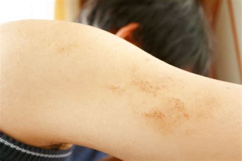 Hyperpigmentation Arms