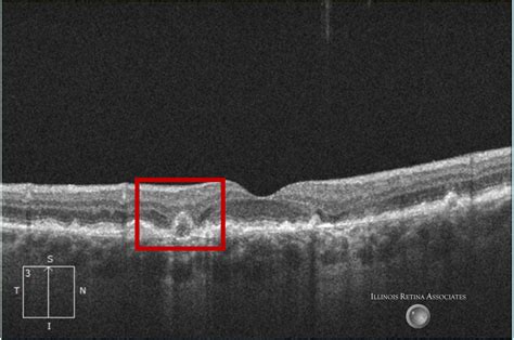 Geographic Atrophy February 2023 Illinois Retina Associates™ Top Retina Specialists In