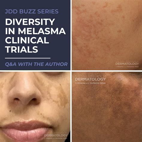 Skin Disorders In People Of Color Archives Next Steps In Dermatology