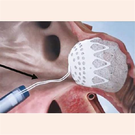 Cardiovascular Innovations And Applications On Linkedin Percutaneous