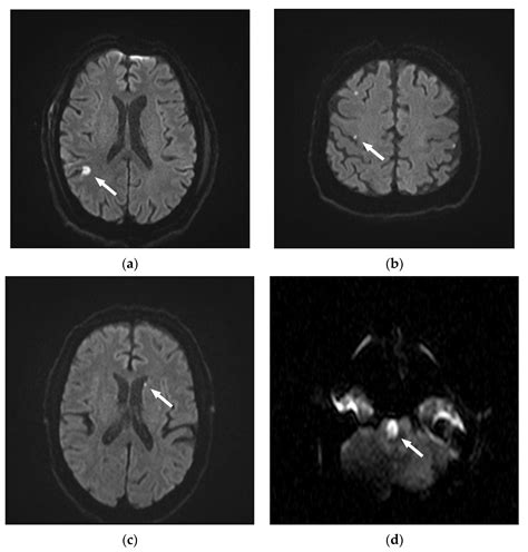 Frequency And Pattern Of Mri Diffusion Restrictions After Diagnostic Catheter Neuroangiography