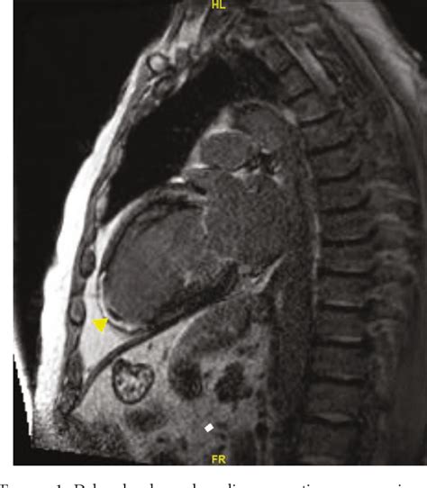 Figure 1 From Recurrence Of Lv Thrombus In A Patient With Severe