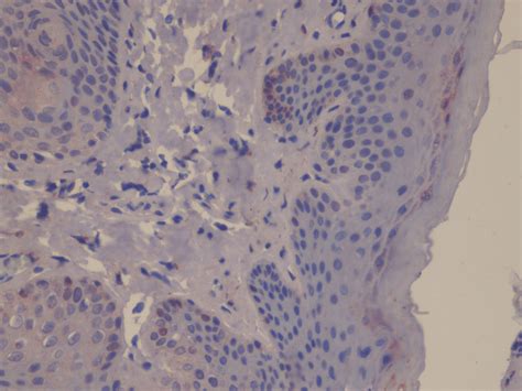 A No P53 Expression Was Present In Squamous Hiperplasia